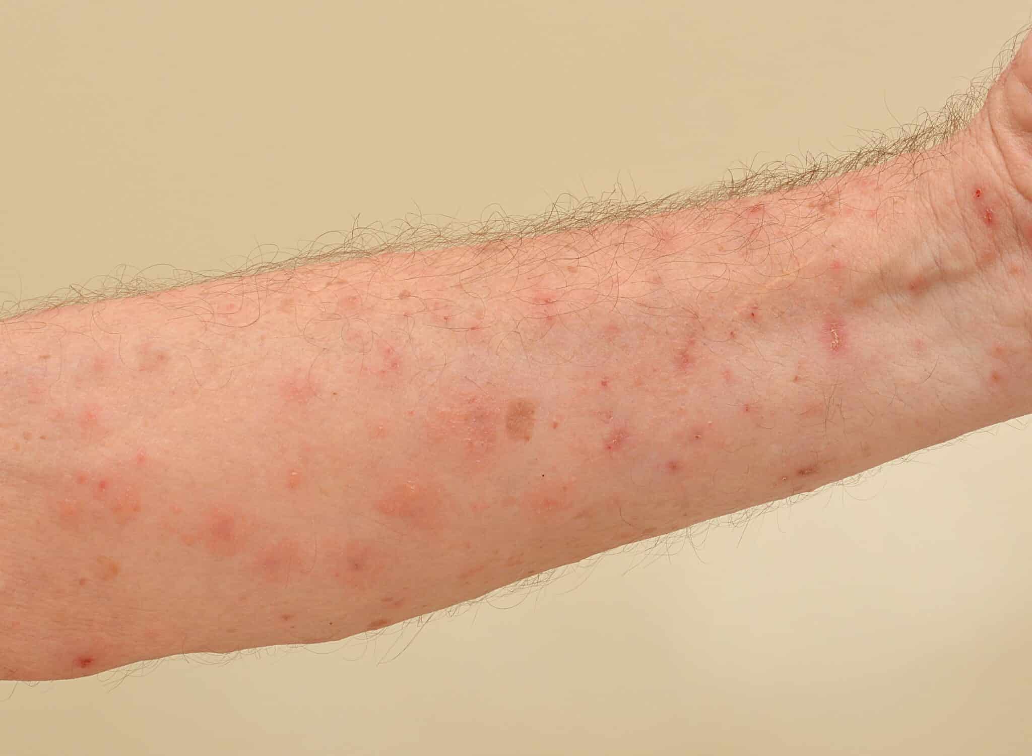 Krätze Ursachen: Wie kommt es zur Scabies-Infektion?